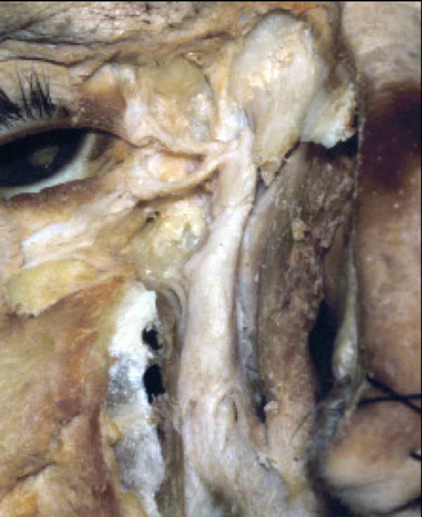 Dacryocystorhinostomy - EyeWiki