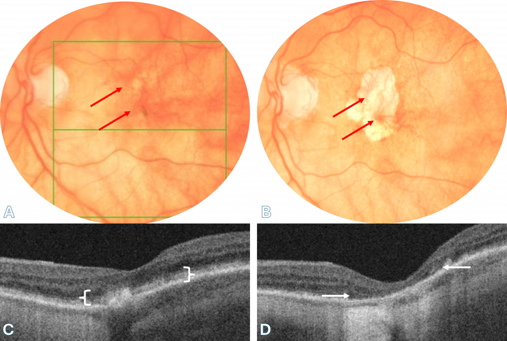 Choroidal Vascular Anomalies: Posterior Vortex Veins, Choroidal ...