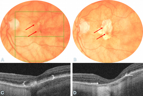 Choroidal Vascular Anomalies: Posterior Vortex Veins, Choroidal ...