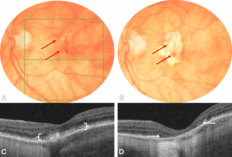 Choroidal Vascular Anomalies: Posterior Vortex Veins, Choroidal ...