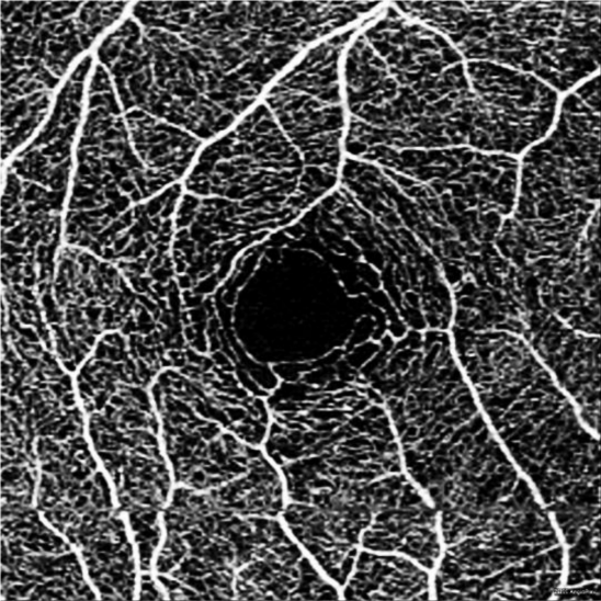 Optical Coherence Tomography Angiography - EyeWiki