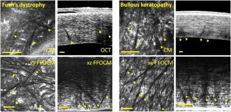 Vogt’s Striae - EyeWiki