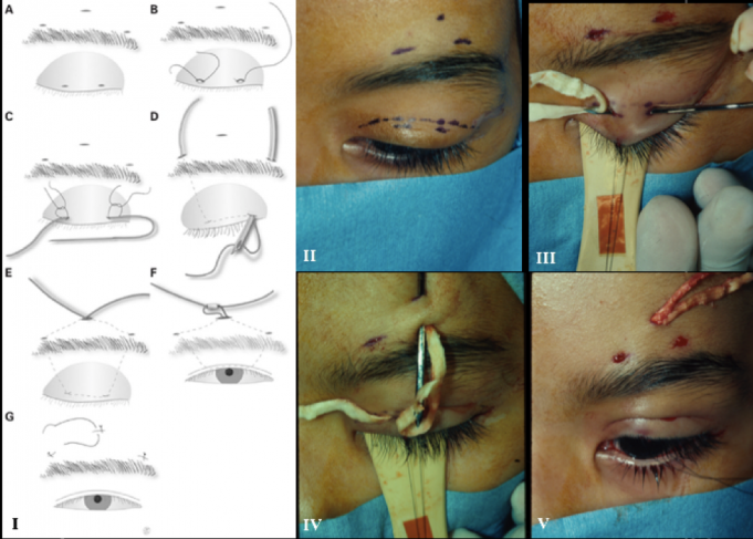 Frontalis Suspension Procedure - EyeWiki