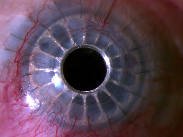 Boston Type 1 Keratoprosthesis - EyeWiki