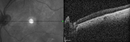 Foveal Hypoplasia - EyeWiki