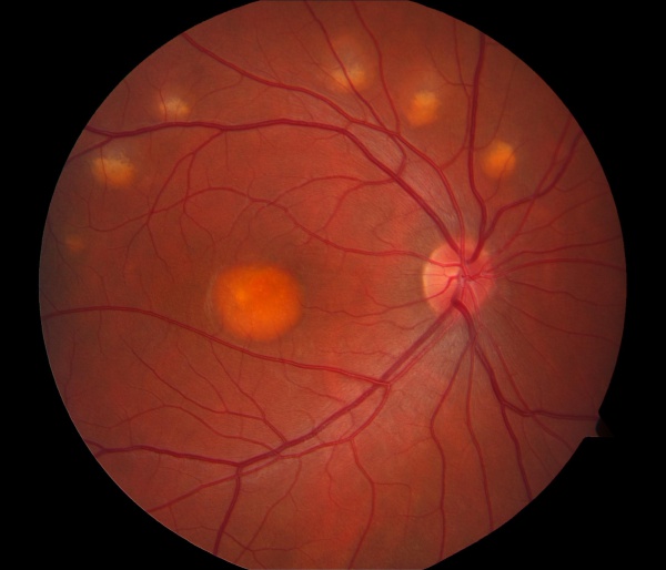 Best Disease and Bestrophinopathies - EyeWiki