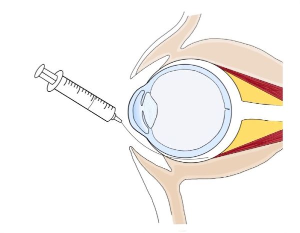 Anesthesia in Vitreoretinal Surgery - EyeWiki