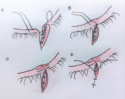 Eyelid Reconstruction - EyeWiki
