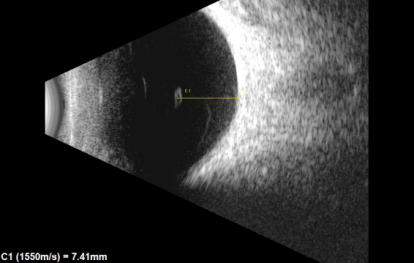 Laser Vitreolysis - EyeWiki