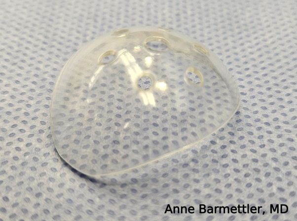 Ocular Prostheses, Scleral Shells, and Conformers - EyeWiki