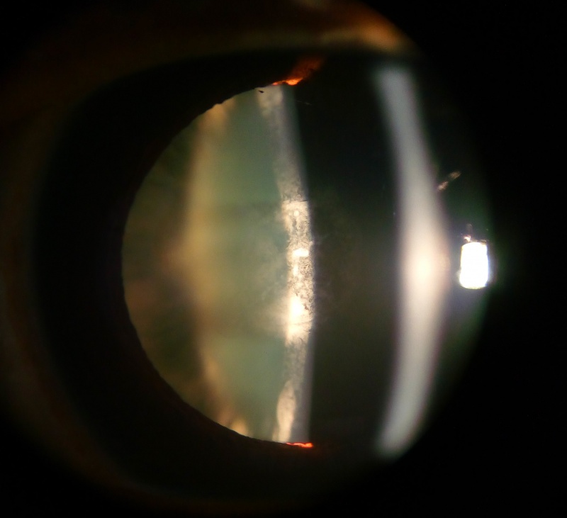 Cataract - EyeWiki