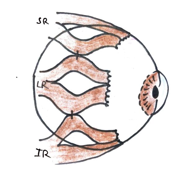 Strabismus Surgery, Cyclovertical - EyeWiki