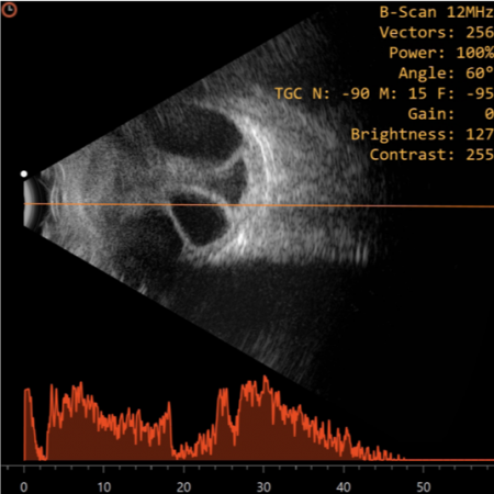 Imaging in Ocular and Ocular Adnexal Trauma - EyeWiki