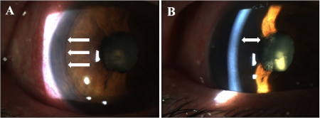 Iris Retraction Syndrome - EyeWiki