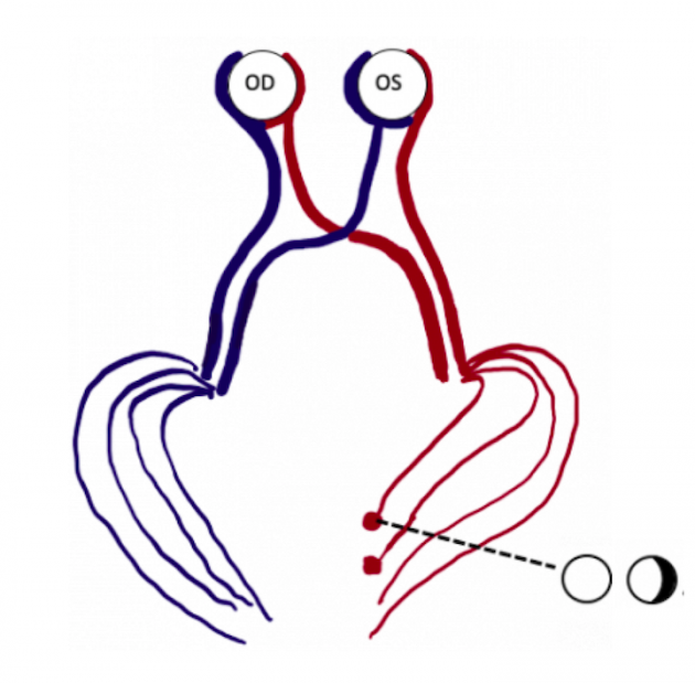 Monocular Occipital Temporal Crescent Syndrome - EyeWiki