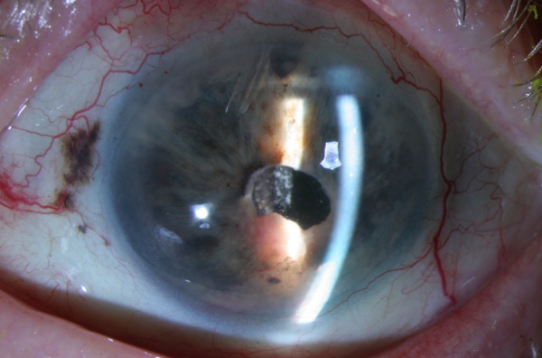 Choroidal and Ciliary Body Melanoma - EyeWiki