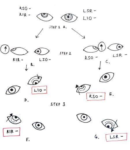 Strabismus Surgery, Cyclovertical - EyeWiki