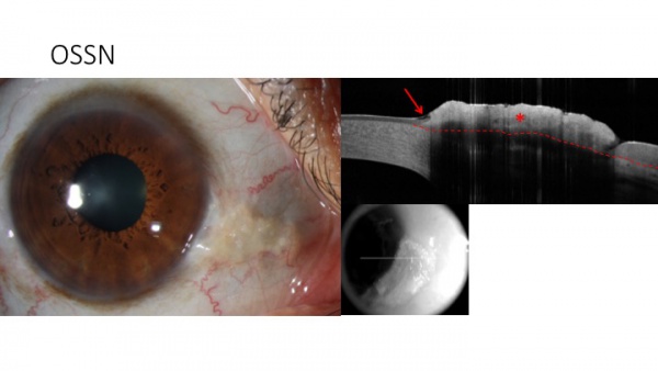 Anterior Segment Optical Coherence Tomography for Various Ocular ...