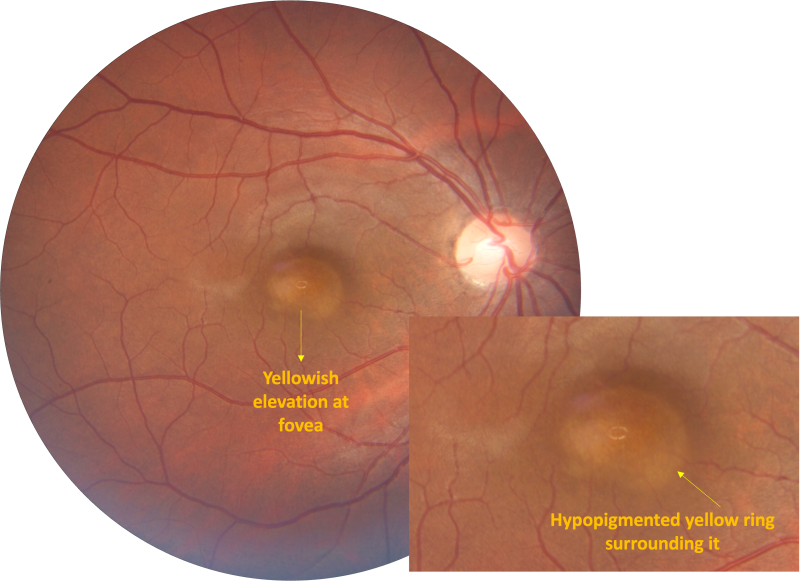 Bacillary Layer Detachment in Retina - EyeWiki
