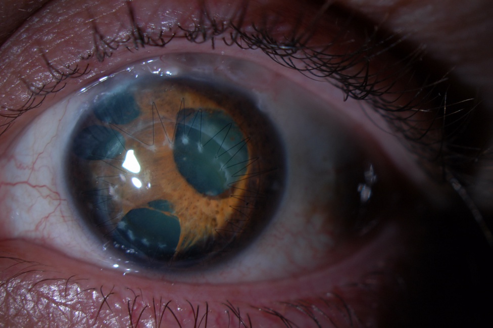 Iridocorneal Endothelial Syndrome and Secondary Glaucoma - EyeWiki