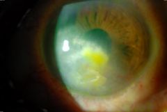 Herpes Simplex Virus Stromal Keratitis and Endotheliitis - EyeWiki