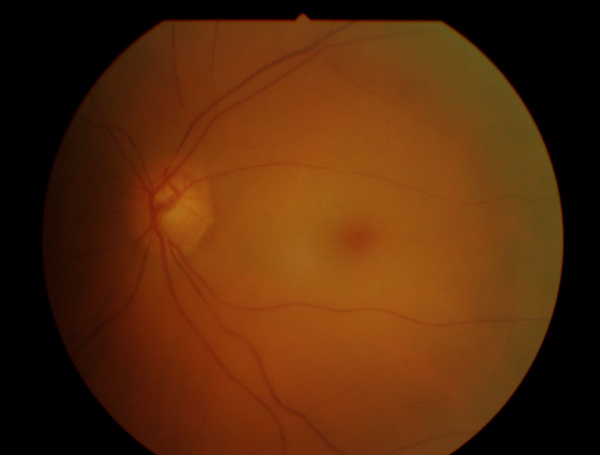 Retinal Artery Occlusion - EyeWiki