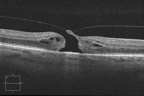 Optical Coherence Tomography - EyeWiki