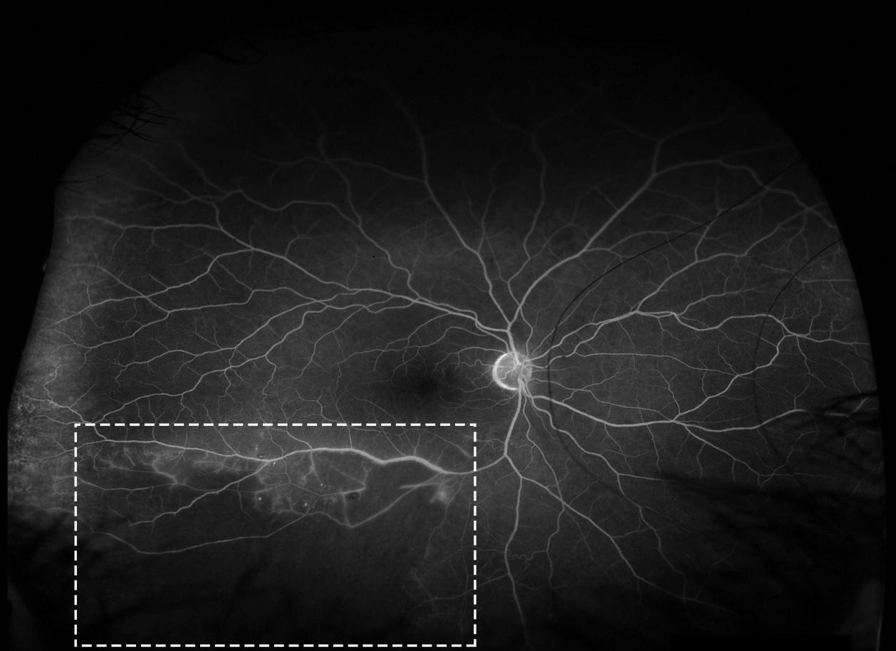 Retinal Vasculitis - EyeWiki