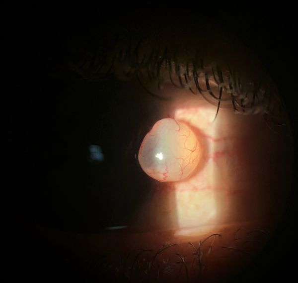 Conjunctival Inclusion Cyst - EyeWiki