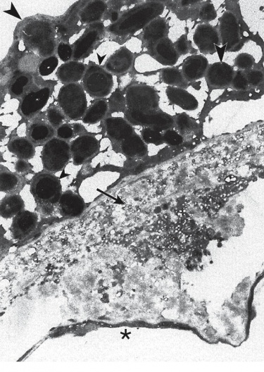 Pattern Dystrophies - EyeWiki