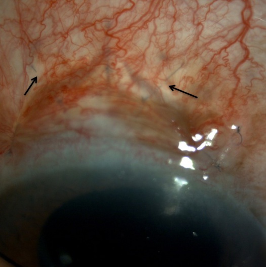 Laser Suture Lysis Post Trabeculectomy - EyeWiki