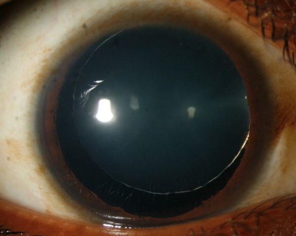Microspherophakia - EyeWiki