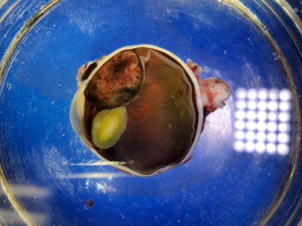 Choroidal and Ciliary Body Melanoma - EyeWiki