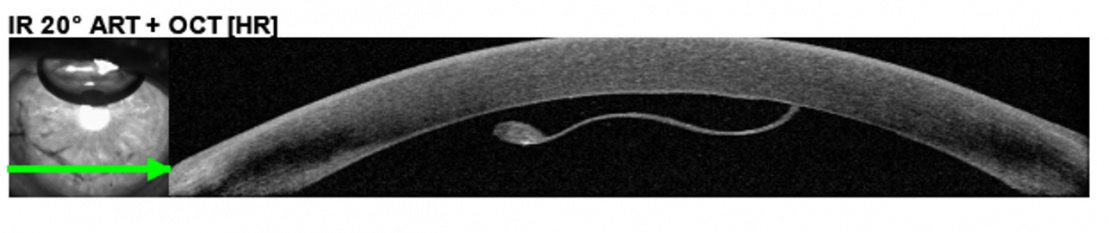 Cataract Surgery Following Cornea Transplant - EyeWiki
