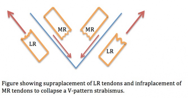 Pattern Strabismus - EyeWiki
