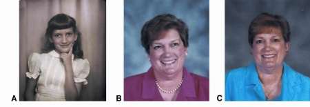 Ocular Torticollis - EyeWiki
