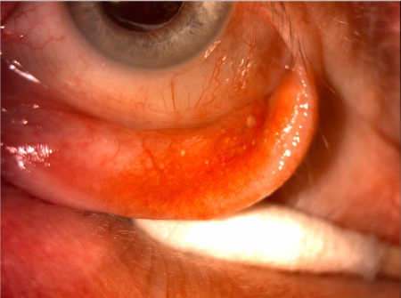 Conjunctival Concretions - EyeWiki