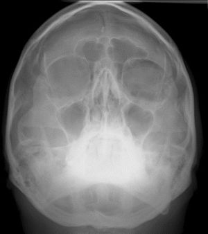 Orbital Emphysema - EyeWiki