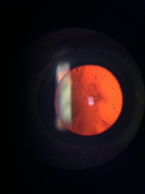 Cataract - EyeWiki