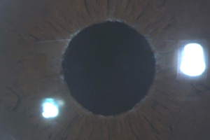 pseudoexfoliative glaucoma