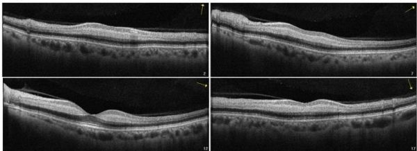 Paracentral Acute Middle Maculopathy - EyeWiki