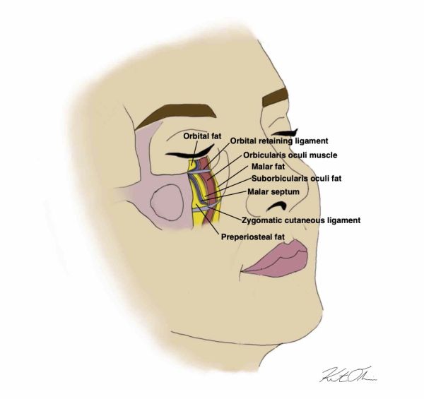 Malar / Midface Descent - EyeWiki