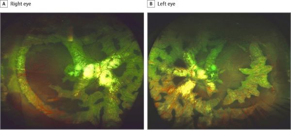 Helicoid Peripapillary Chorioretinal Degeneration - EyeWiki