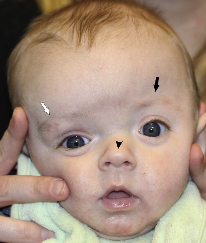 Unilateral Coronal Synostosis - EyeWiki