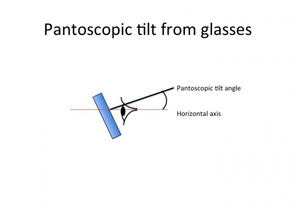 Intraocular Lens (IOL) Tilt and Astigmatism - EyeWiki
