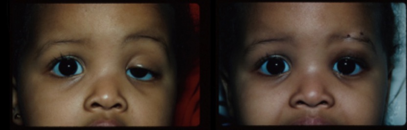 Frontalis Suspension Procedure - EyeWiki