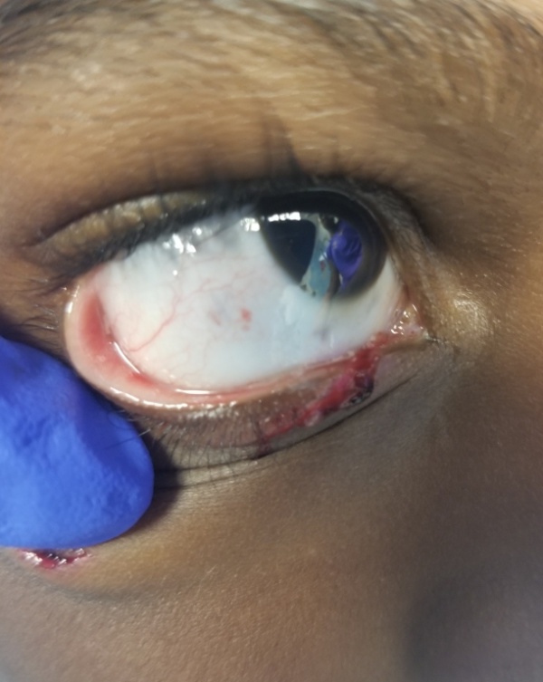 Dog Bites (periocular) - EyeWiki