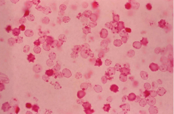 Ghost Cell Glaucoma - EyeWiki