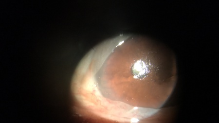 Conjunctivochalasis Eyewiki