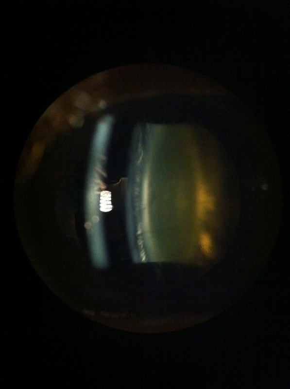 Cataract - EyeWiki